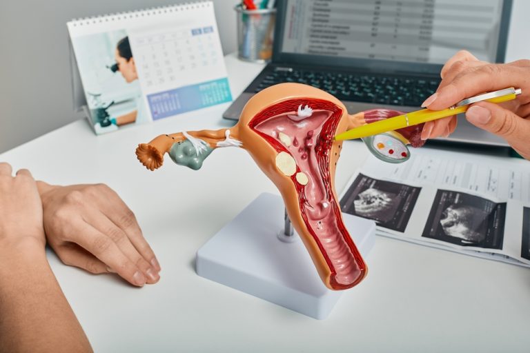 How to Treat Uterine Polyps in Howard County (A Complete Guide)